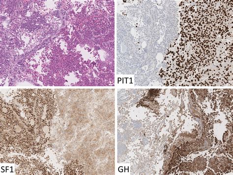 Double Pitnet The Coexistence Of Multiple Pitnets Is Not Uncommon