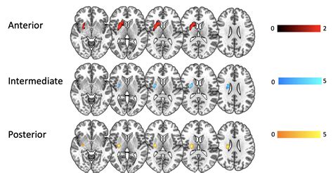 Ls Compilation Pic Stroke Maps