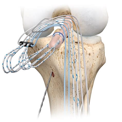 Toggleloc® Flip Inline With Ziploop® Technology Acl Suspensory Button