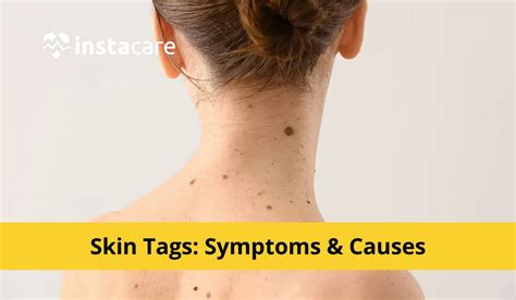 Skin Tags Symptoms Causes And Treatment Options