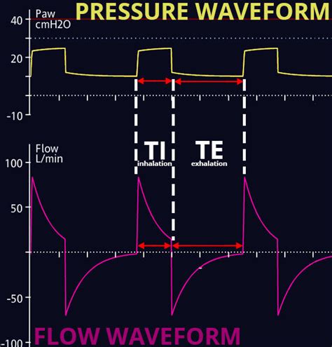 Ventilator Waveform Anatomy The Basics You Gotta Know