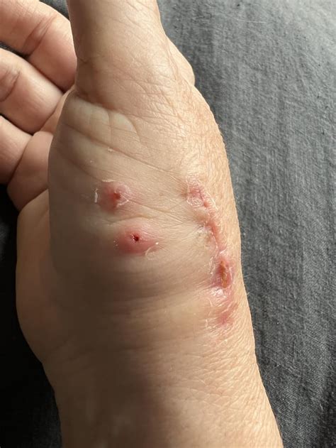 Update On Cmc Joint Arthroplasty R Medizzy