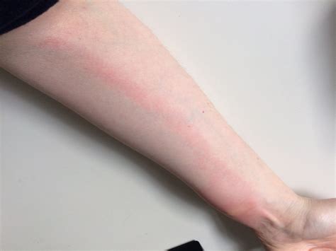 Lymphangitis Lymfangitis Rode Pijnlijk Streep Op Arm Of Been