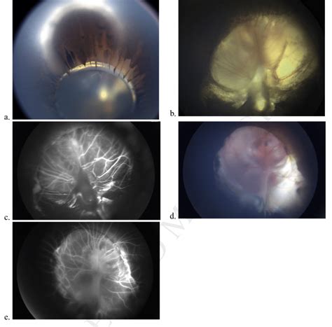 A Patient From Case 2 Inferiorly Displaced Small Lens With Elongated