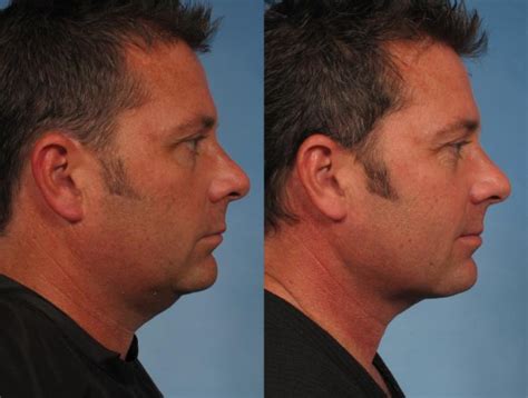 Plastic Surgery Before And After Men Face