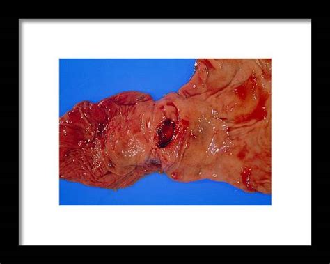 Bleeding Gastric Ulcer