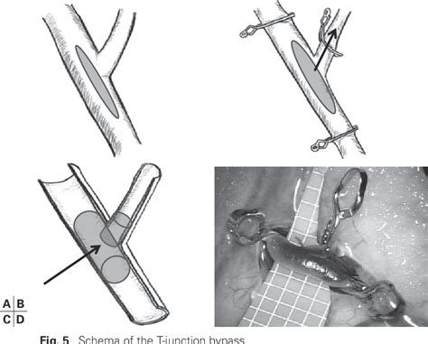 Figure 2 From Surgical Tips For Sta Mca Bypass From Misato Central