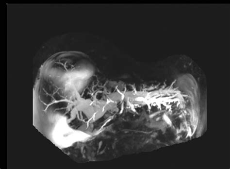 Magnetic Resonance Cholangiopancreatography Image Demonstrating A Download Scientific Diagram