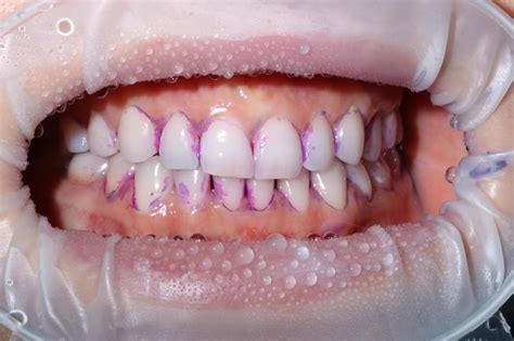 Профессиональная гигиена полости рта в Санкт-Петербурге ...