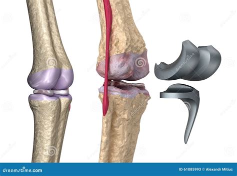 Knee And Titanium Hinge Joint Royalty Free Stock Image 19182814