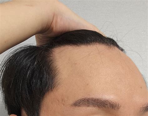 디에이성형외과 3500모 비절개 수술 2일차 첫후기 모발이식 후기리뷰비용은 대다모