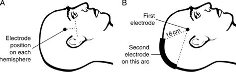 Anaesthesia For Electroconvulsive Therapy Continuing Education In