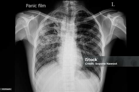 결핵 환자의 가슴 Xray 필름 X 레이에 대한 스톡 사진 및 기타 이미지 X 레이 건강관리와 의술 결핵균 Istock