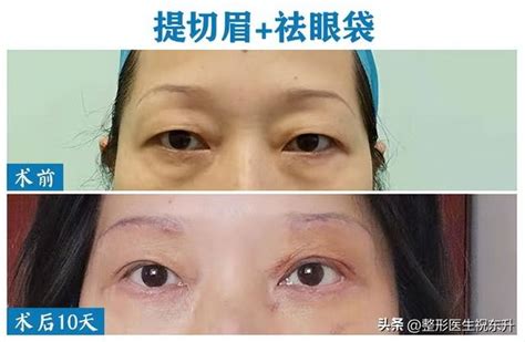 推薦幾個適合普通人做的醫美項目，評價好、性價比高的那種 每日頭條