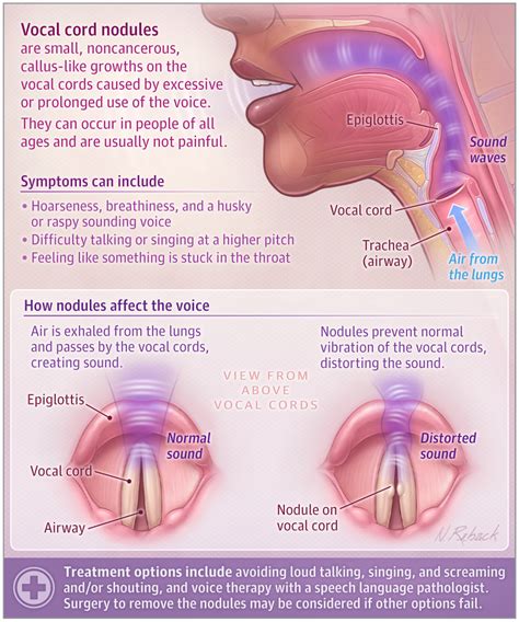 What Are Vocal Cord Nodules Laryngology Jama Otolaryngology Head