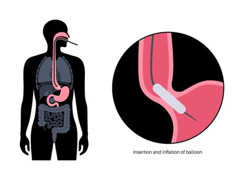 Premium Vector Endoscopic Pneumatic Dilation Upper Endoscopy