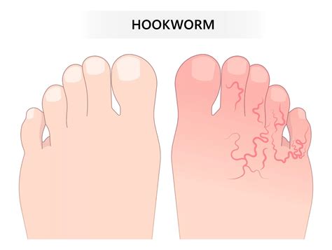 Hookworm Infection Causes Symptoms Prevention