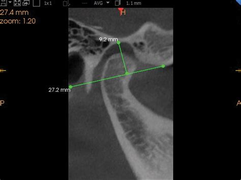 Three Dimensional Assessment Of Condylar Morphology Position And