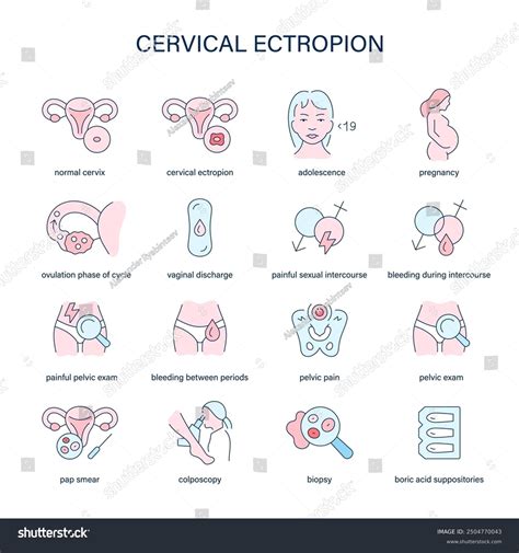 Cervical Ectropion Symptoms Diagnostic Treatment Vector Stock Vector Royalty Free 2504770043