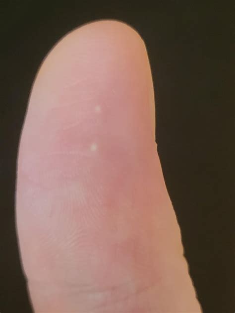 White Zit Like Bumps On Fingertip Rdermatologyquestions