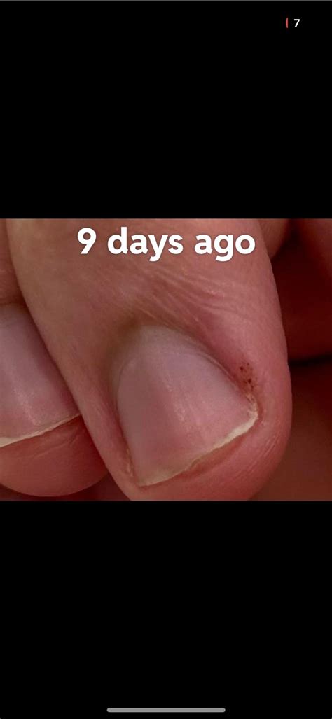 Is The Wart Dying Rwarts