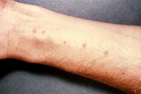 Human Hookworm