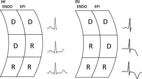 A Theory To Explain Twave Inversion In Myocarditis In A Normal Heart Download Scientific