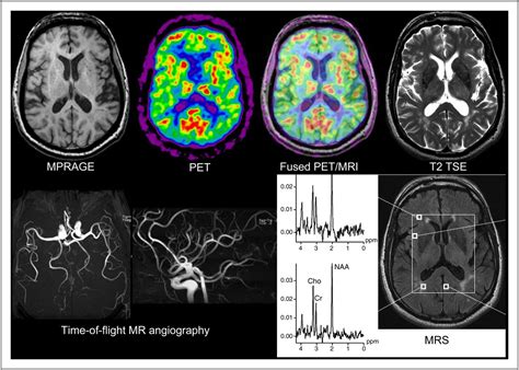 PET MRI For Neurologic Applications Journal Of Nuclear Medicine