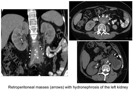Diagnostic Imaging Of Perinephric Space
