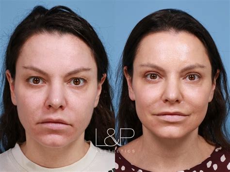 Blepharoplasty Before And After Landp Aesthetics