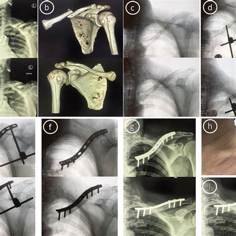 A Displaced Midshaft Clavicle Fracture Aoota 152a In A 49 Year Old