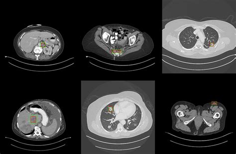 The Detection Results Of Yolo V3 In The Deeplesion Dataset The Green Download Scientific