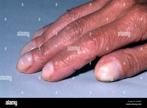 Finger Clubbing Clubbing Wikem