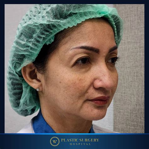 ผลลัพธ์ 3 สัปดาห์ ศัลยกรรมดึงขมับและ Sub Brow Lift แก้ไขหนังตาตกด้วยวิธีซ่อนแผลไว้ใต้คิ้ว หน้า