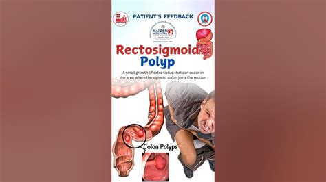 𝐏𝐚𝐭𝐢𝐞𝐧𝐭 𝐅𝐞𝐞𝐝𝐛𝐚𝐜𝐤 Mr Manoj Gandhi Kaizen Hospital Rectosigmoid Colon Junction Polyp Youtube