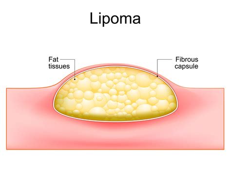 Lipoma Symptoms Causes Stages Diagnosis And Treatment Oncodaily