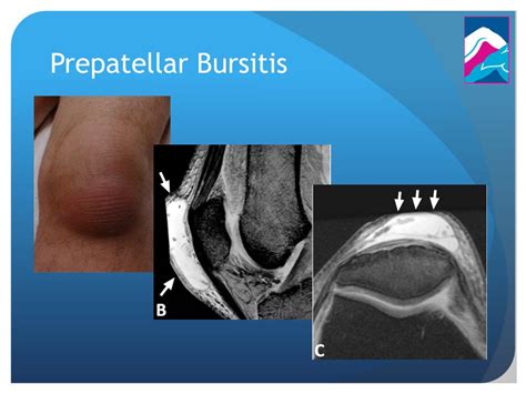 Ppt Knee Pain Powerpoint Presentation Free Download Id5039596