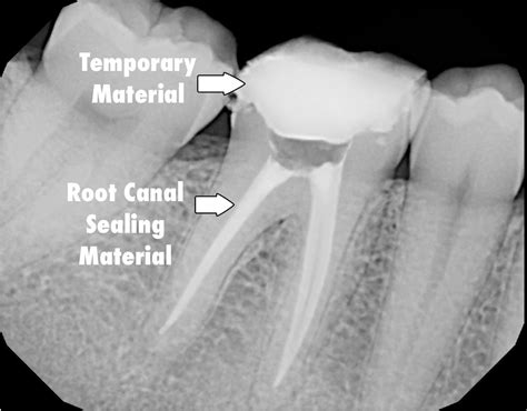 What Is A Root Canal Buildup And Crown Advance Dental Pc Dentist