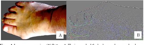 Figure 4 From Development Of Hallux Valgus Classification Using Digital