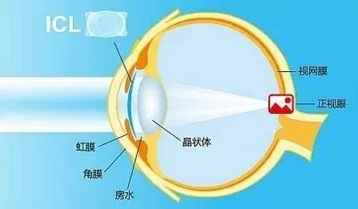 icl近视植入晶体危害 德视佳