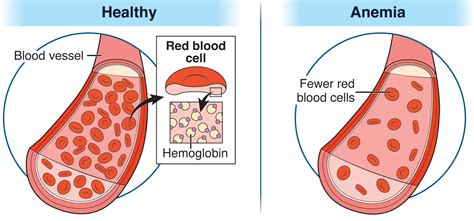 Iron Deficiency Anemia Aga Gi Patient Center