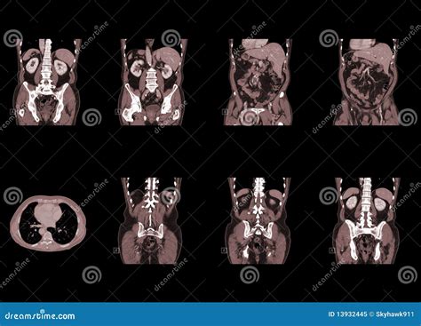 Computed Tomography Of Chest And Abdomen Stock Image Image Of