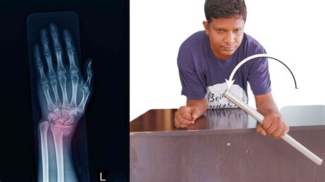 Clavicle Fracture Physiotherapy Rehab Protocol Simplified To Get Back