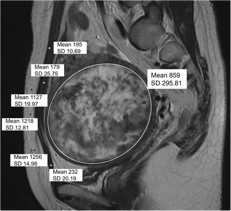 The Predictive Effect Of Quantitative Analysis Of Signal Intensity Heterogeneity On T2 Weighted