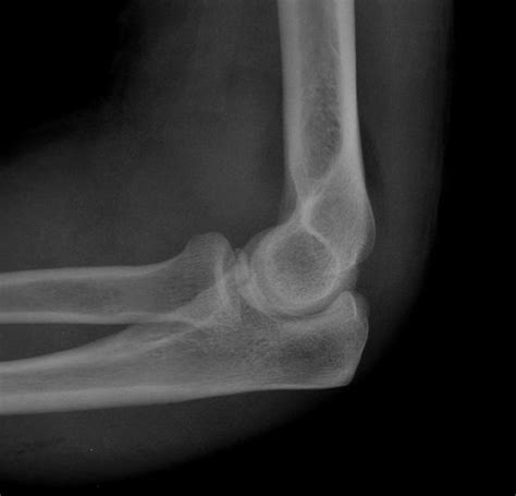Coronoid Process Radiography