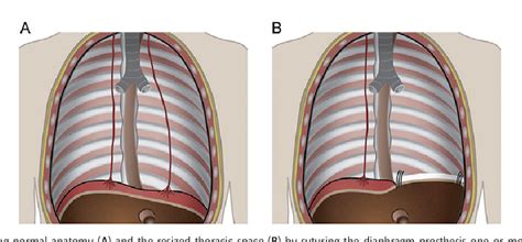 figure 1 from thoracic shaping technique to avoid residual space after