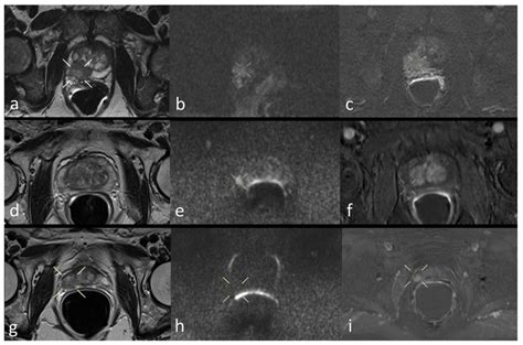 Prostate Mpmri Of Three Patients T2wi A Dwi B And Dce Image C