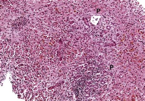 Acute Viral Hepatitis Clinical Tree