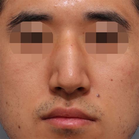 Reshaping Male Nose By Hooked Nose Rhinoplasty Hanabi Rhinoplasty Clinic