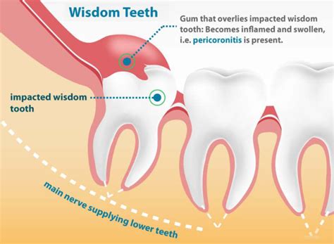 Broken Wisdom Tooth Extraction Cost